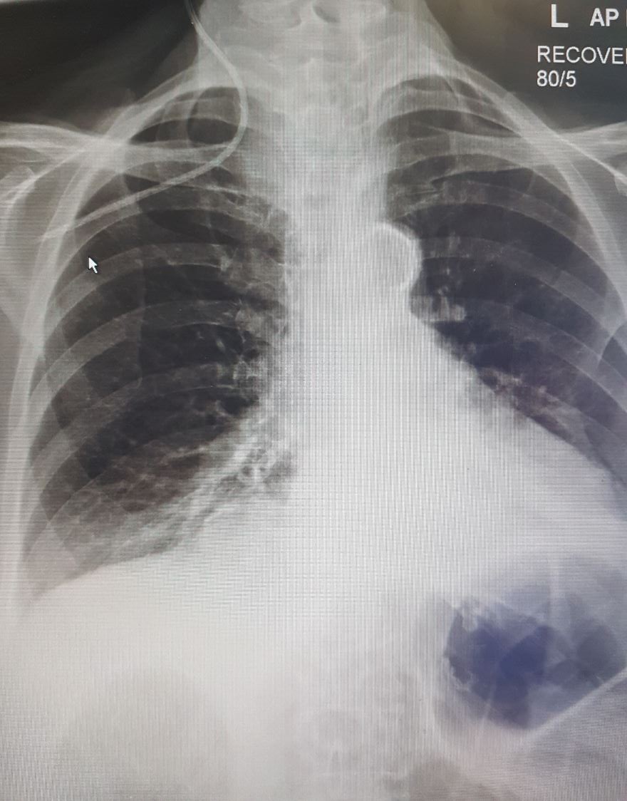 Is Routine Chest X-ray After Ultrasound-Guided Central Venous Catheter ...