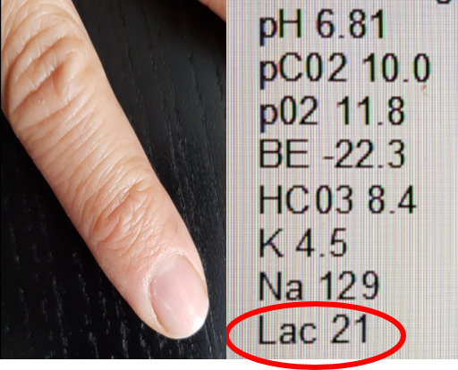 Effect of a Resuscitation Strategy Targeting Peripheral Perfusion ...
